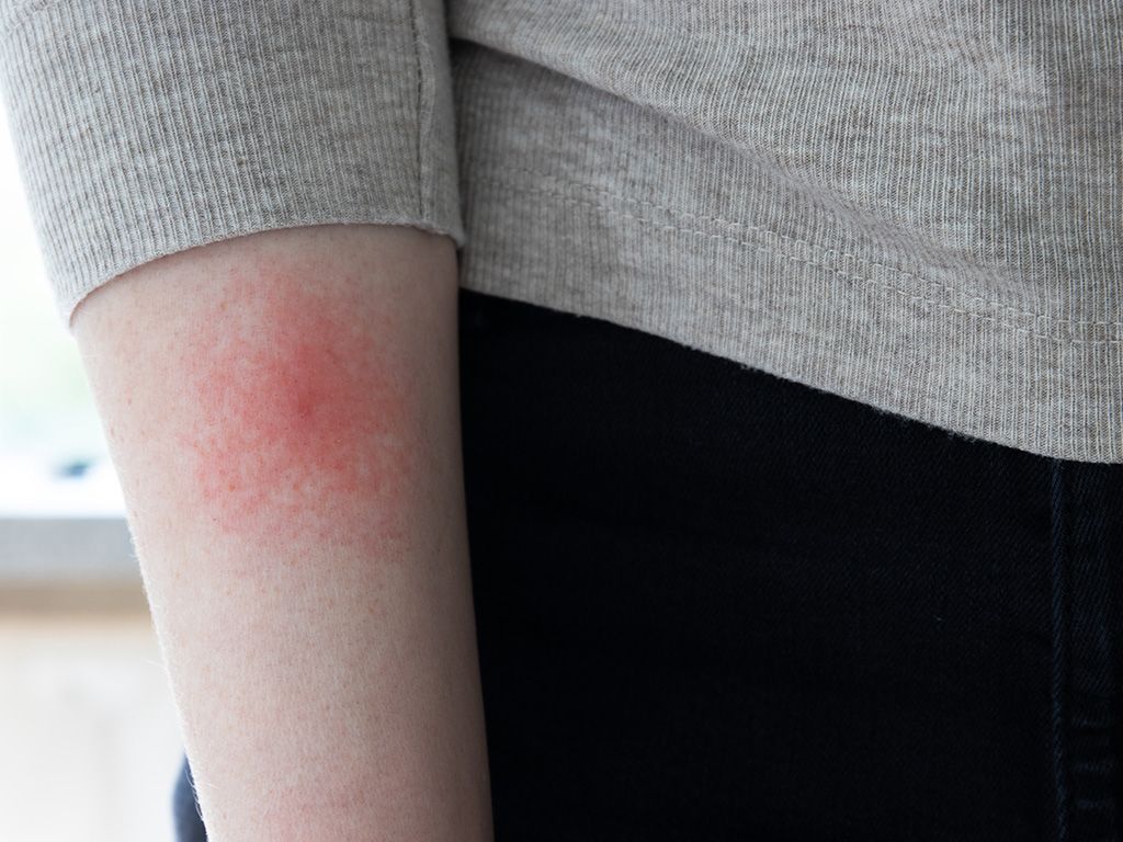 Infectieziekte genoemd naar een dorp in Connecticut: ontdek de ...